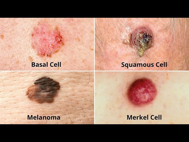 Dog Skin Cancer Symptoms Pictures - Infoupdate.org