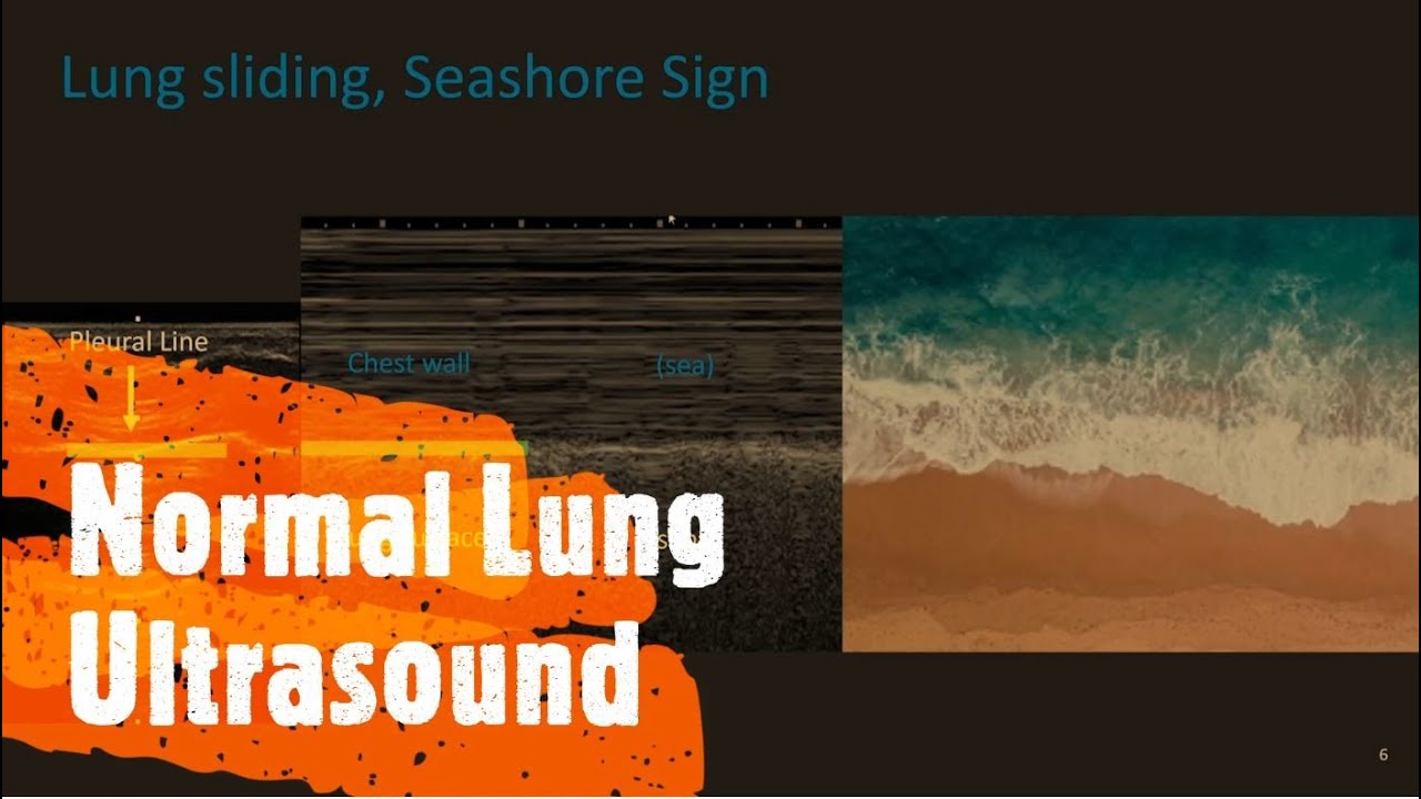 Normal Lung Ultrasound. Perioperative & Critical Care POCUS - YouTube