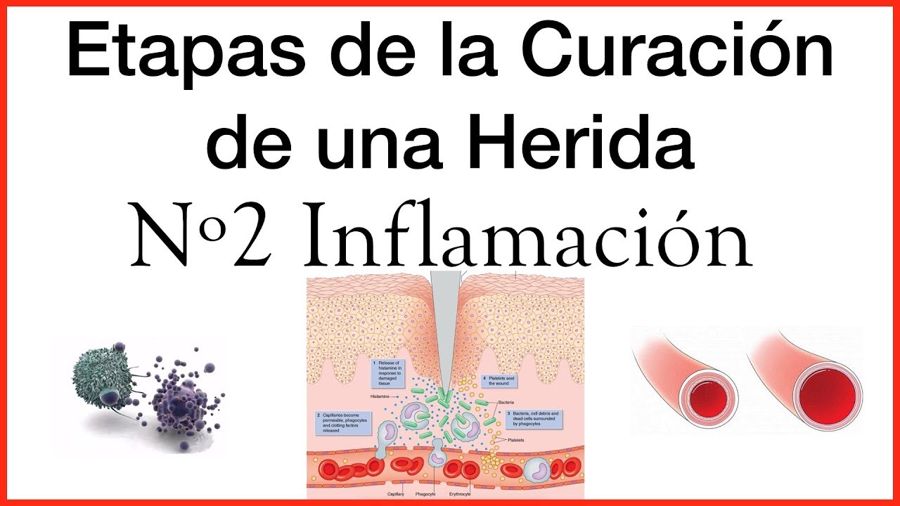 Curación de Heridas, Etapa 2: Inflamación - YouTube