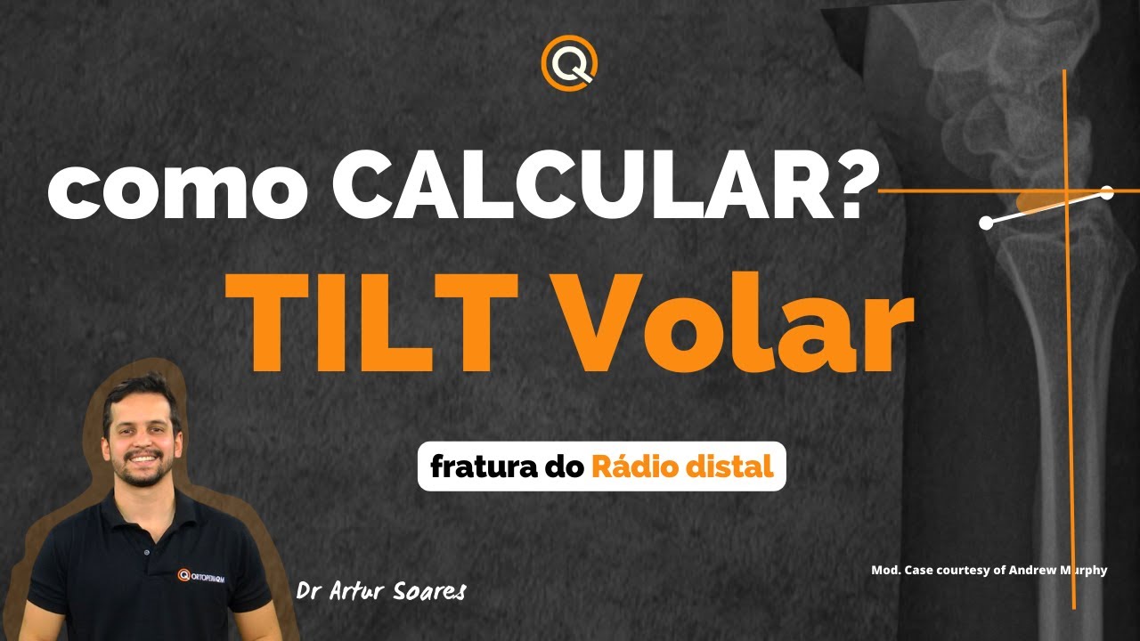 Como calcular o TILT VOLAR do Rádio Distal! Habilidade no TEOT por Dr ...