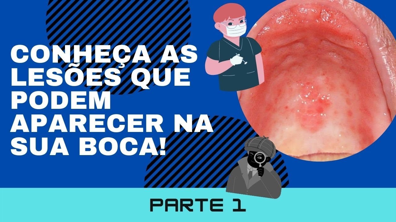 FIQUE ATENTO A ESSAS LESÕES QUE PODEM APARECER NA SUA BOCA ...