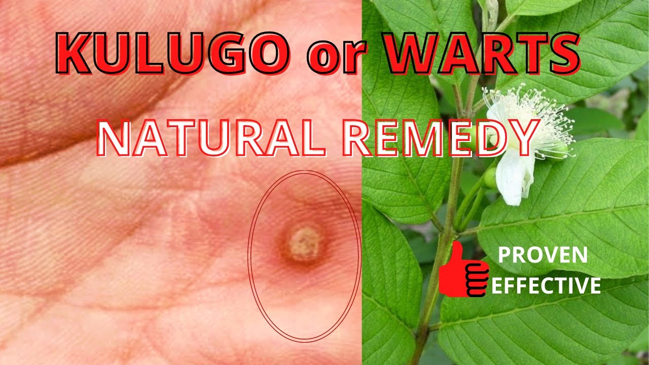 Natural Remedy for Warts-Proven and Effective - YouTube