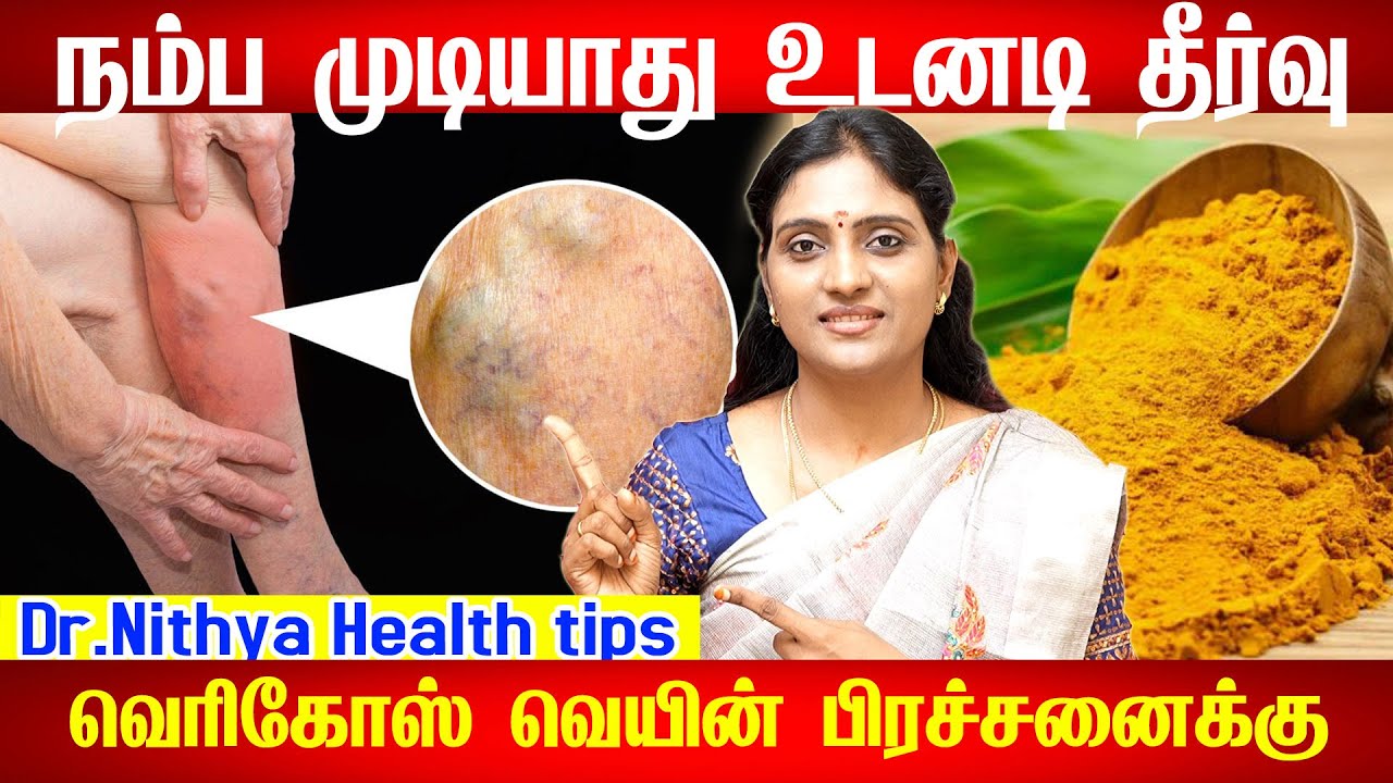 Unbelievable! 🤩வெரிகோஸ் வெயின் அறிகுறிகள் | vericose vein problem in ...