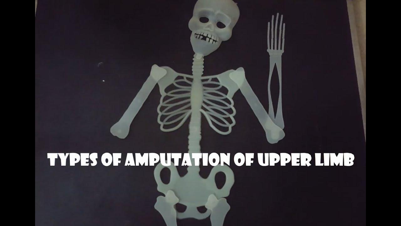 Upper limb amputation types - YouTube