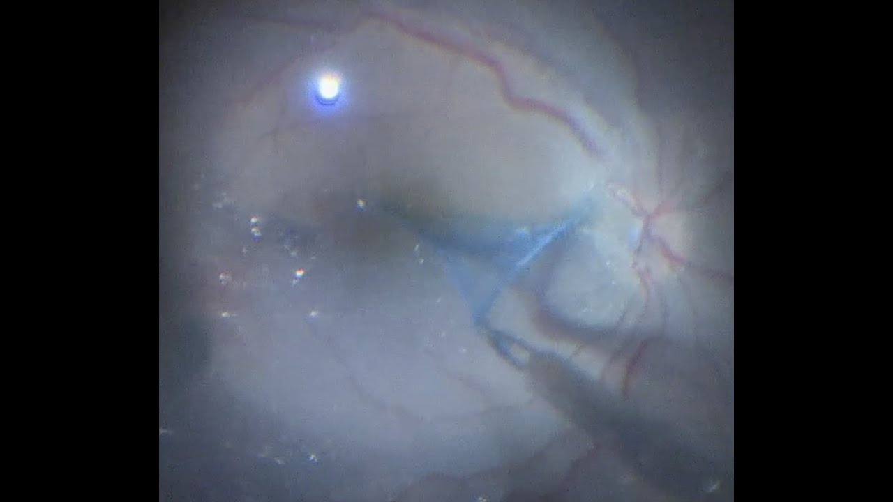 ILM peeling under PFCL, giant retinal tear RD - YouTube