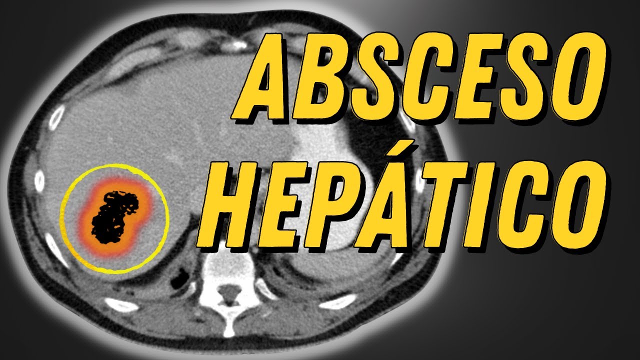 Absceso Hepático Explicado Claramente - YouTube