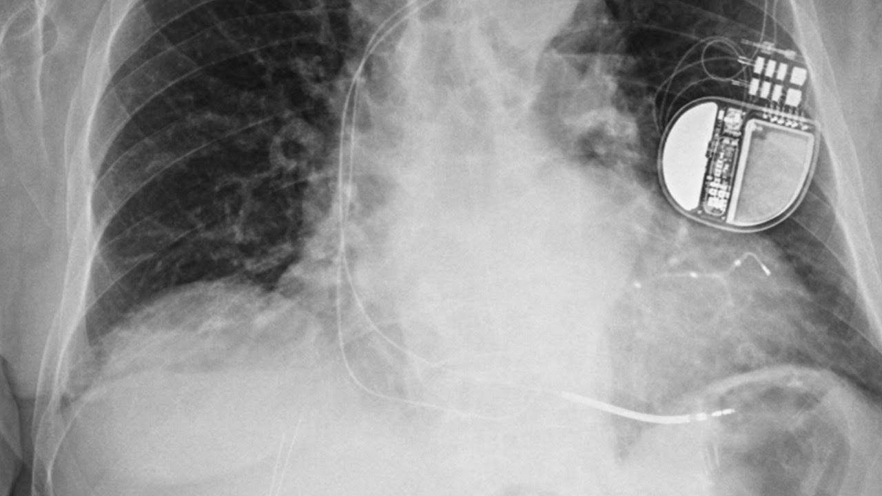 Kalp yetersizliğinde kalp pili tedavileri nelerdir? Kimlere ve nasıl ...