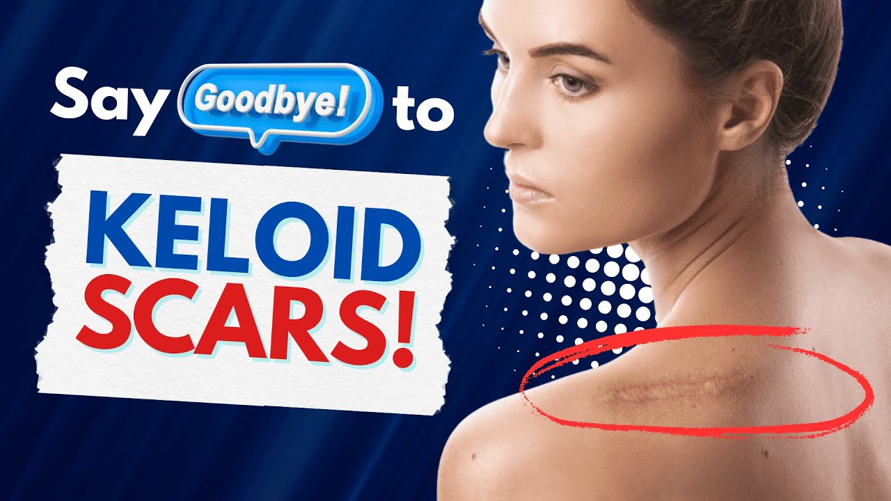 KELOID SCARS - Meaning, Symptoms, Causes, Risks, Treatment & Surgery ...