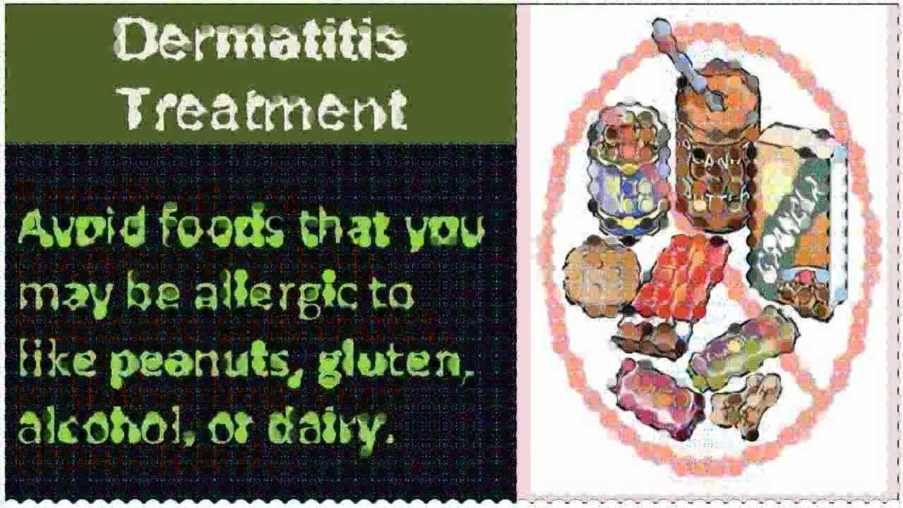 See cercarial dermatitis treatment - Watch now! - YouTube