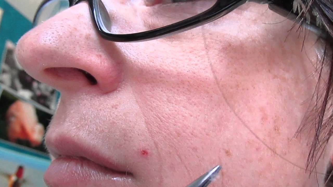 Morgellons treatment, peeling web off face - YouTube