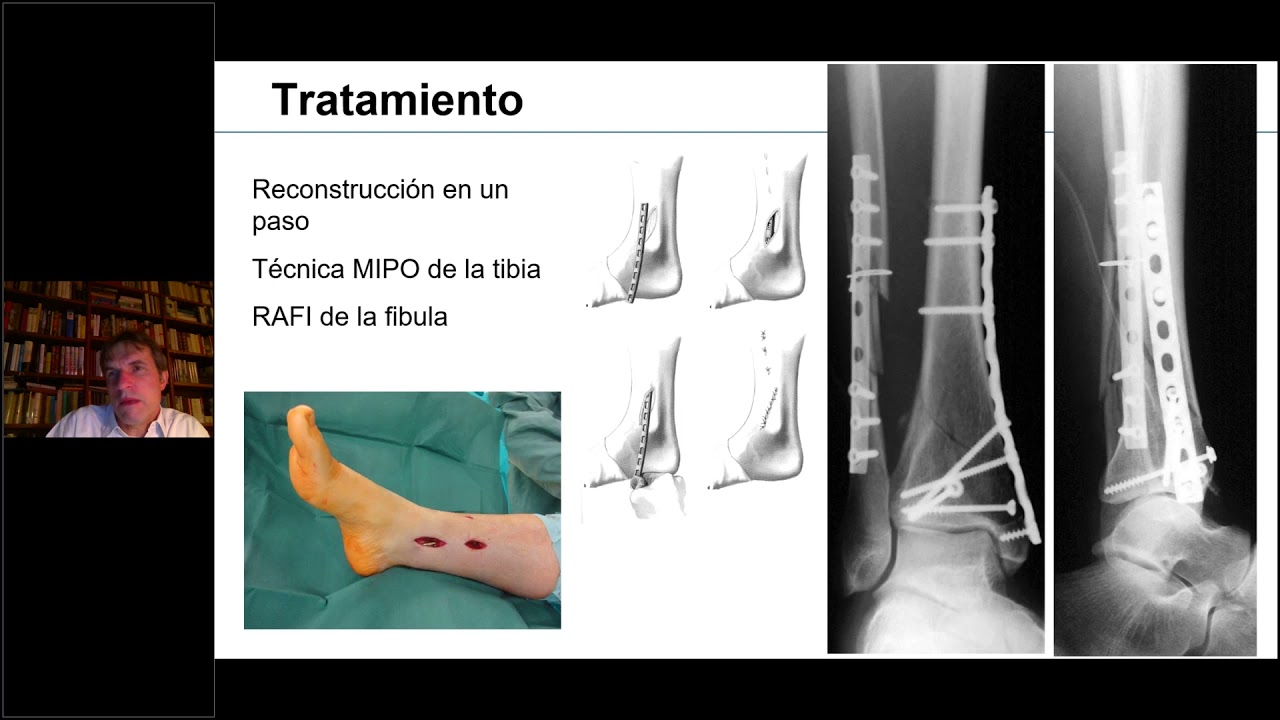 FRACTURAS DEL PILON TIBIAL - YouTube