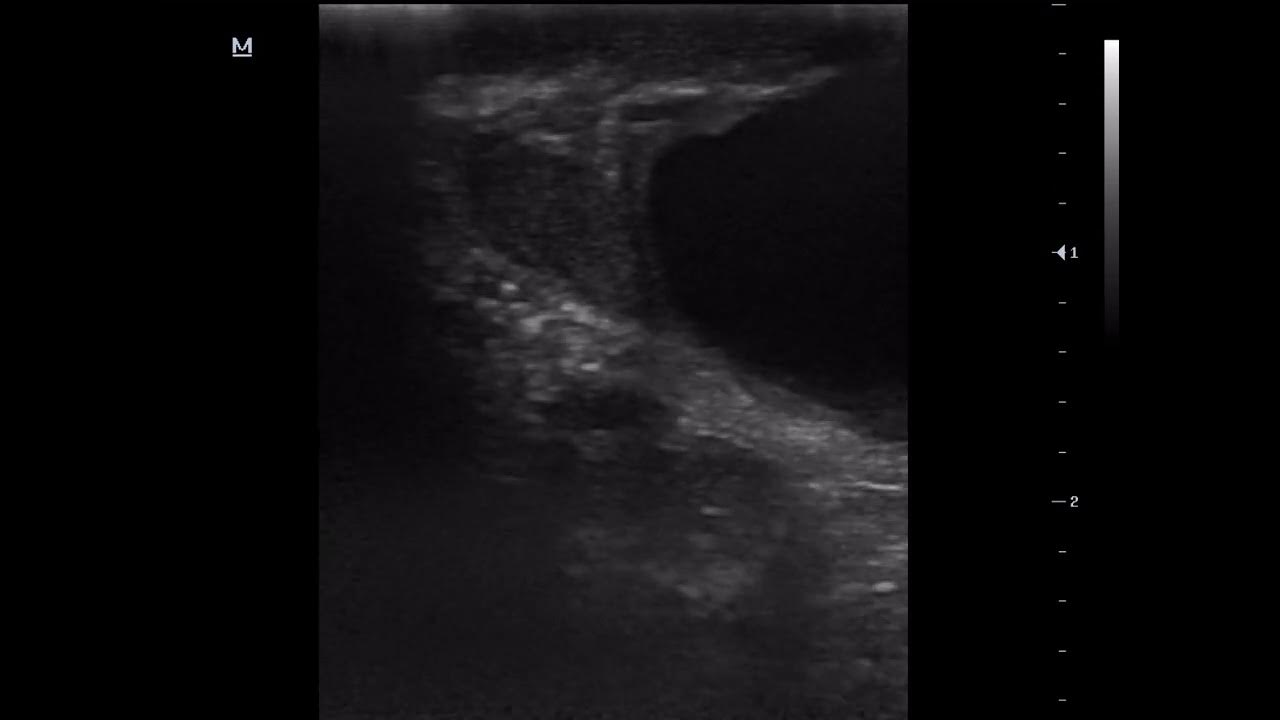 Case 1018 Left Encysted Spermatic Cord Hydrocele Youtube