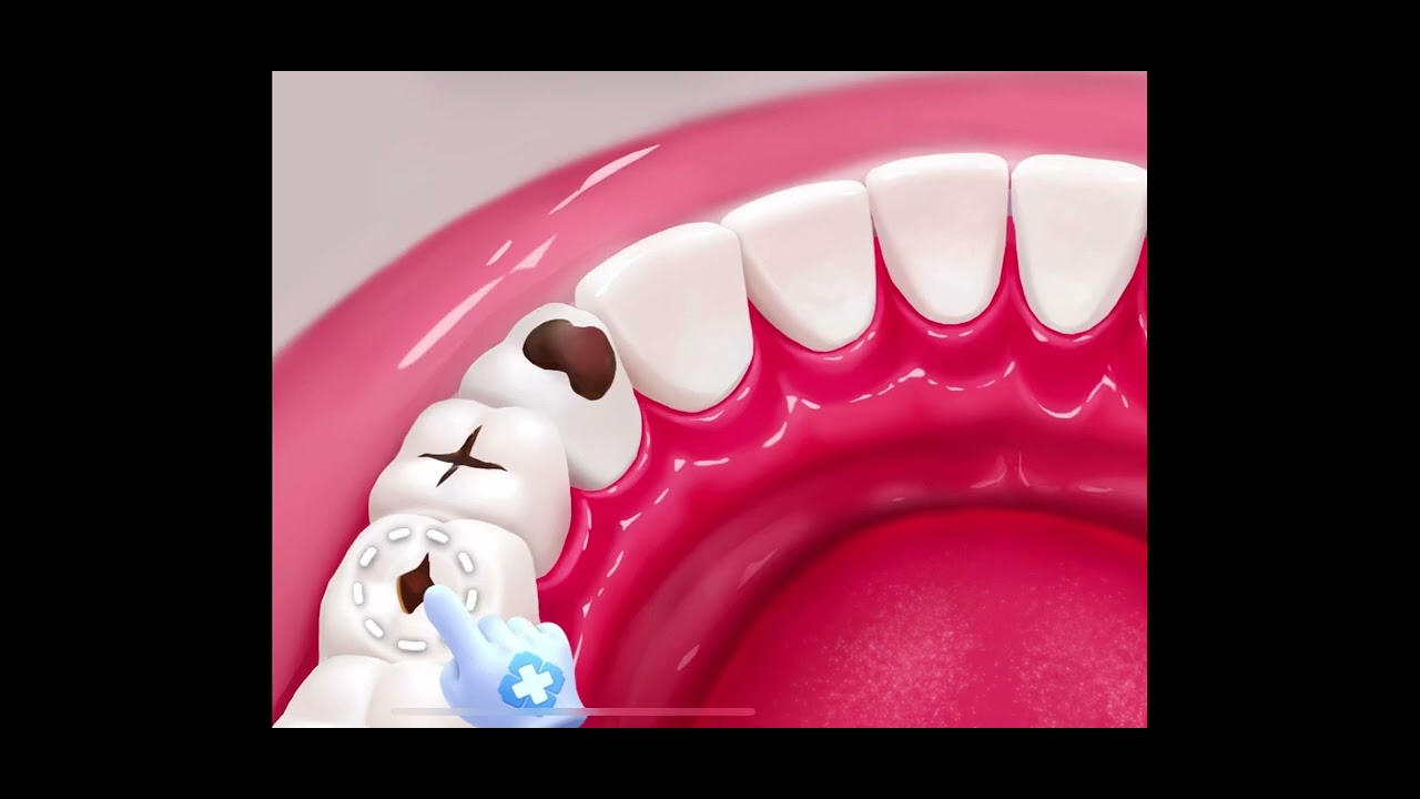 Ultimate Guide to Teeth Cavity Treatment | BeautyByte Animations - YouTube