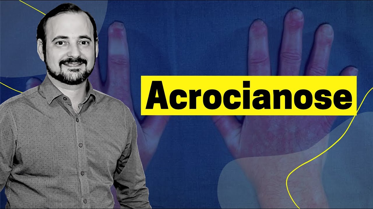 Acrocianose | José Góes - YouTube
