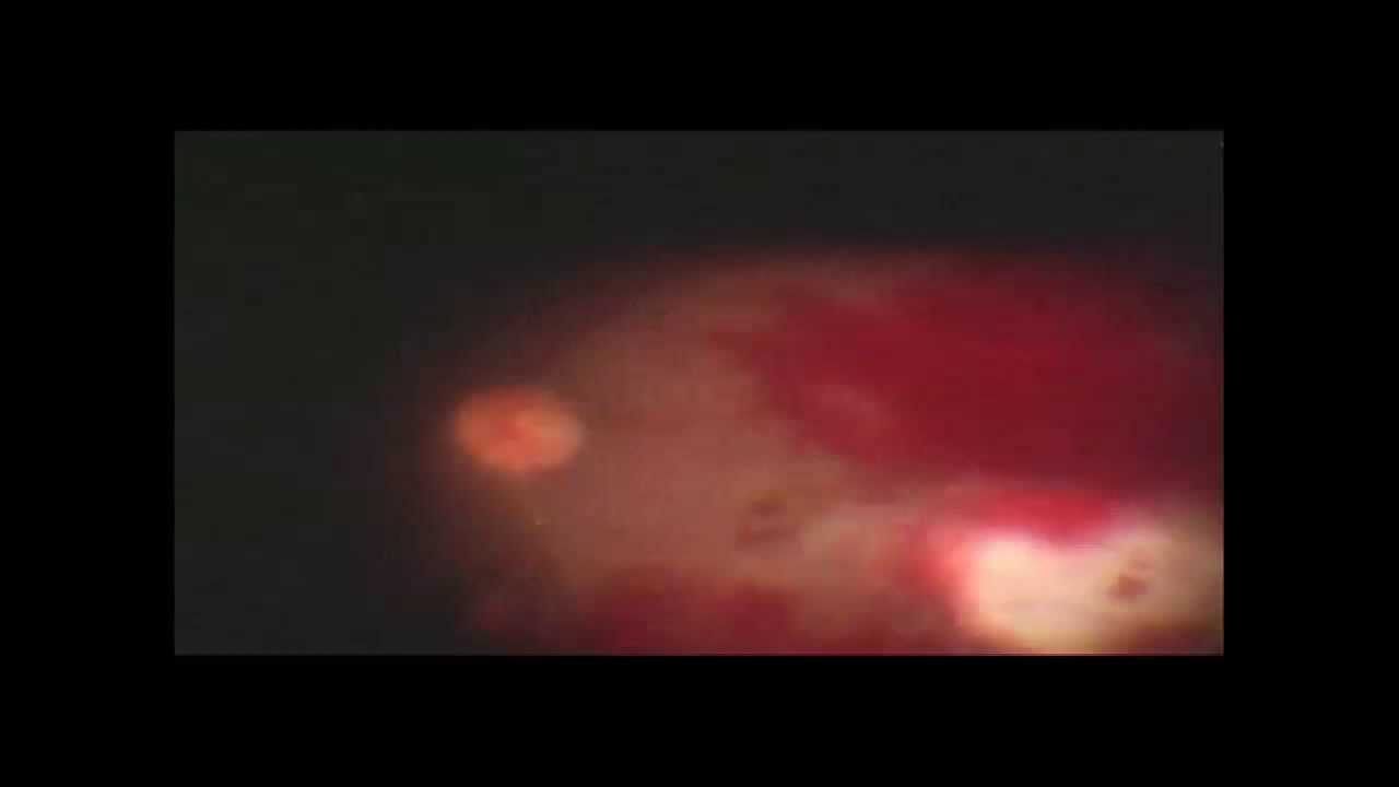 Toxoplasmosis: Subretinal Abscess. A diagnostic dilemma. [Dr. E. M ...