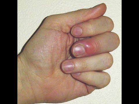 How I handle infected finger ( paronychia ) - YouTube