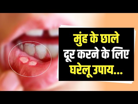 मुंह में छाले होने पर पिएं ये 5 चीजें | Muh Me Chale Ho To Kya Pina ...