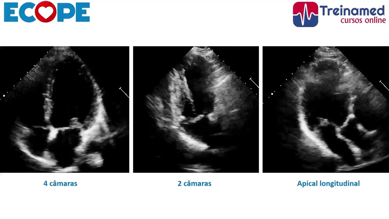 Ecocardiograma Prolapso Da Valva Mitral Prolapso Da Válvula Mitral: