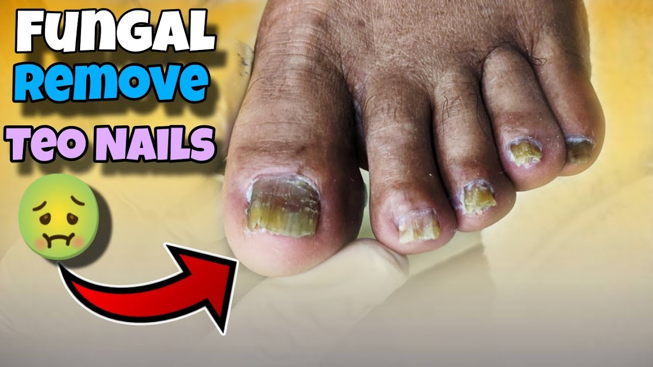 ASMR! Pedicure Nail Fungal Remove easily 🤯 | Complecated condition of ...