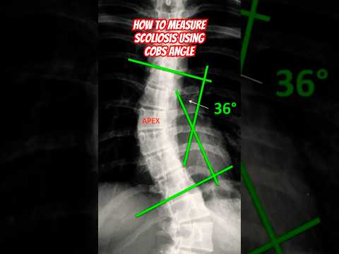 How To Determine Scoliosis Percentage