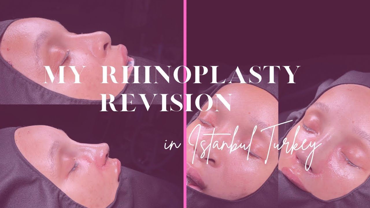 Ethnic Rhinoplasty Revision in Turkey + a surprise procedure! - YouTube