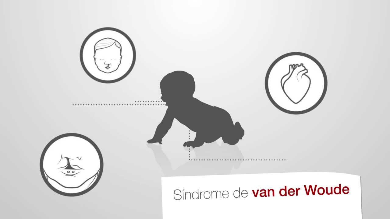 Você sabe o que é Síndrome de Van der Woude? - YouTube
