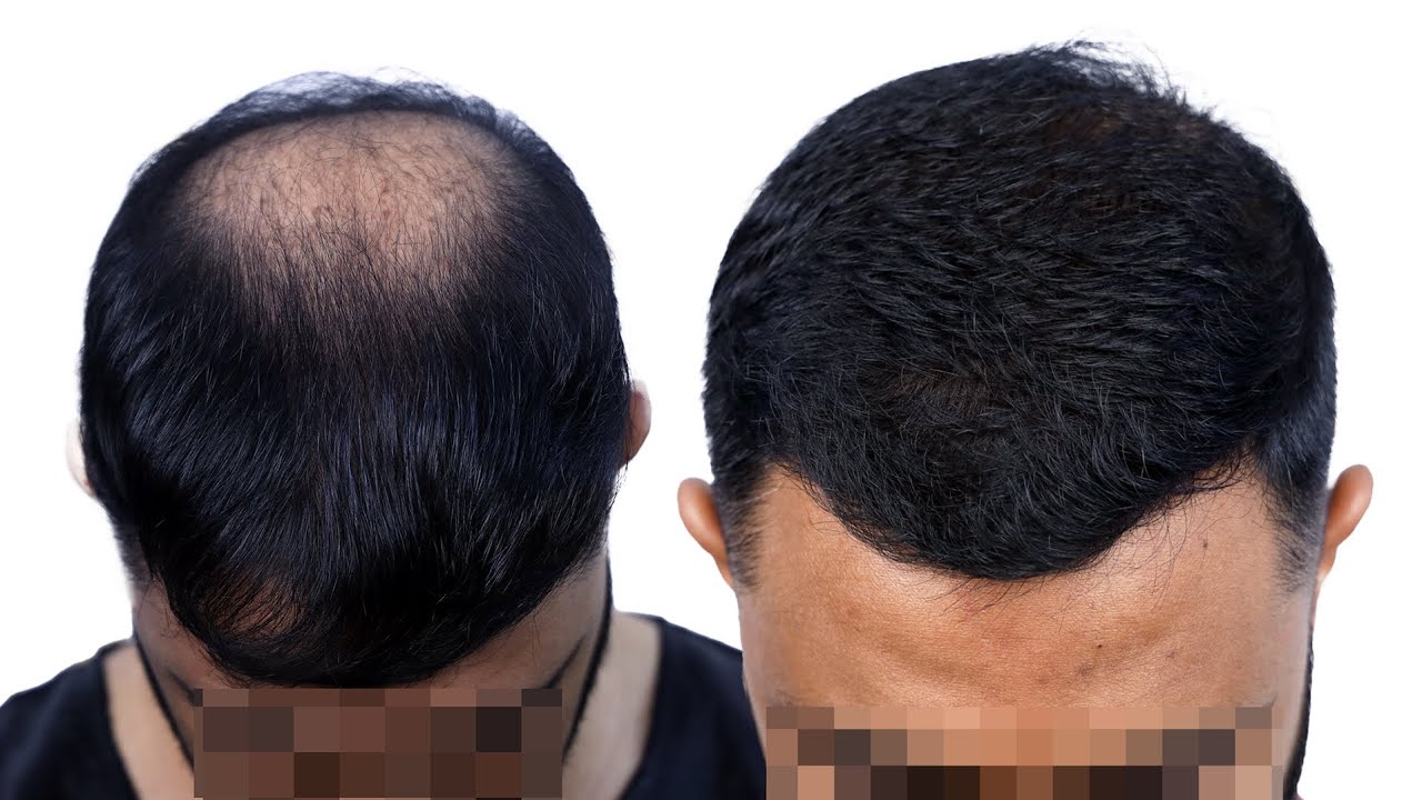 Grade 3 Vertex Baldness Recovery with 4500 Grafts | 9-Month Hair ...