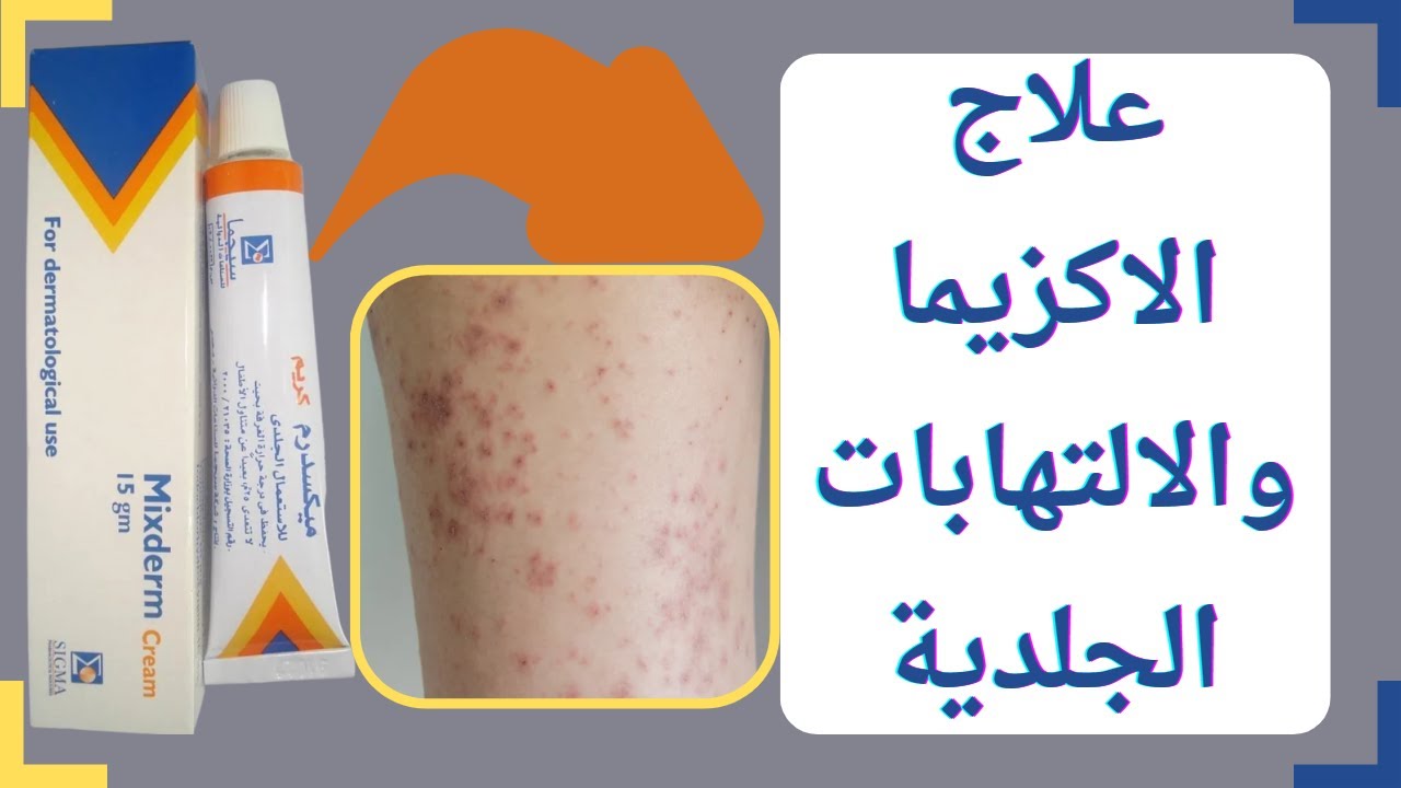 علاج الاكزيما والالتهابات الجلدية ميكسدرم MIXDERM - YouTube