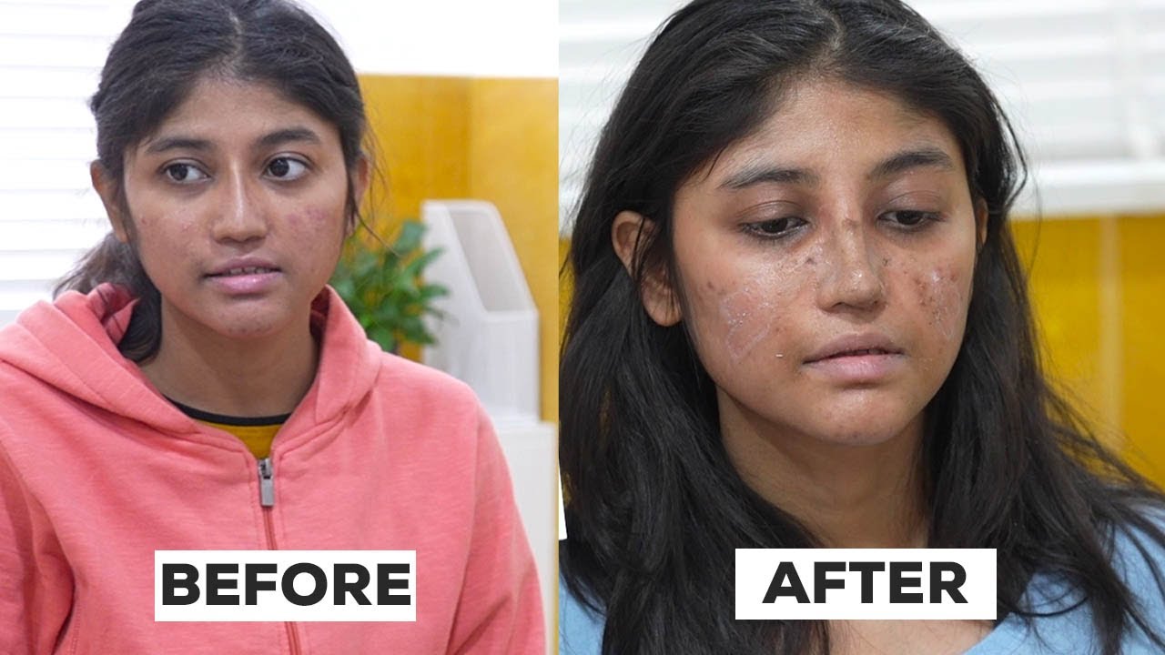 Pretty Girl Amazing Nose Job Results - Before & After - YouTube