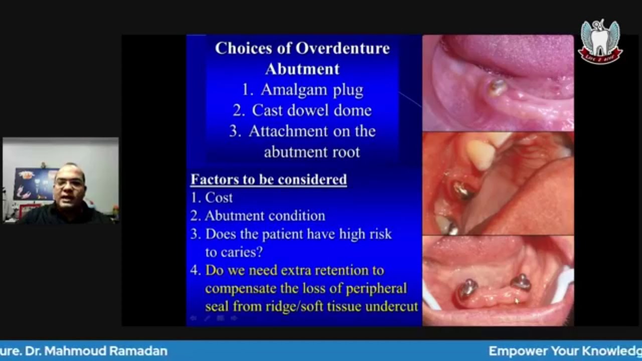 Tooth Supported Overdenture Part 3: Treatment planning and clinical ...