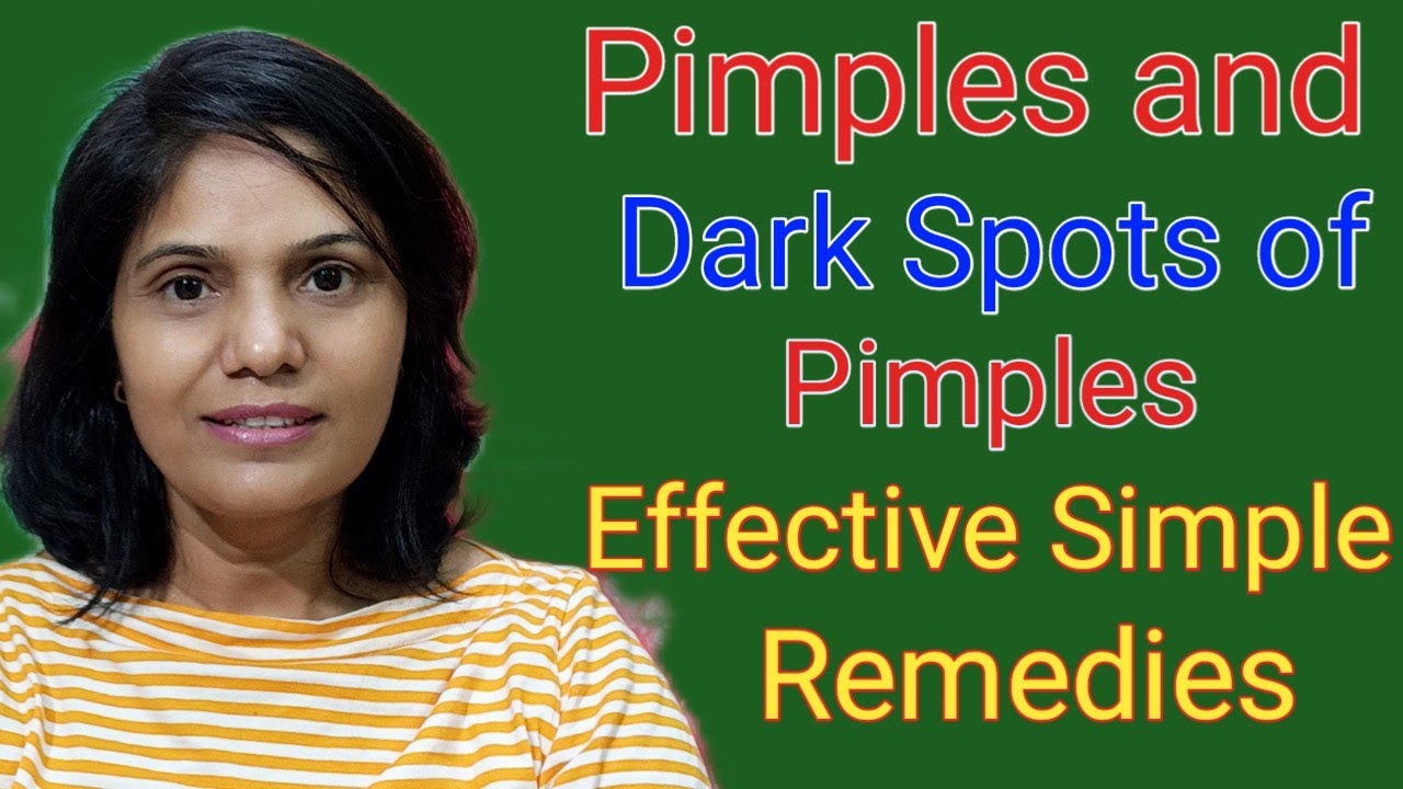 Pimples ke Daag Kaise Hataye. Pimples ke Kale Daag Kaise Hataye - YouTube