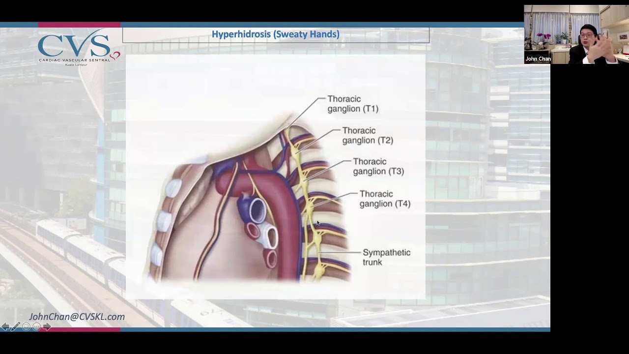 Palmar Hyperhidrosis (sweaty hands) treatment by VATS Sympathectomy ...