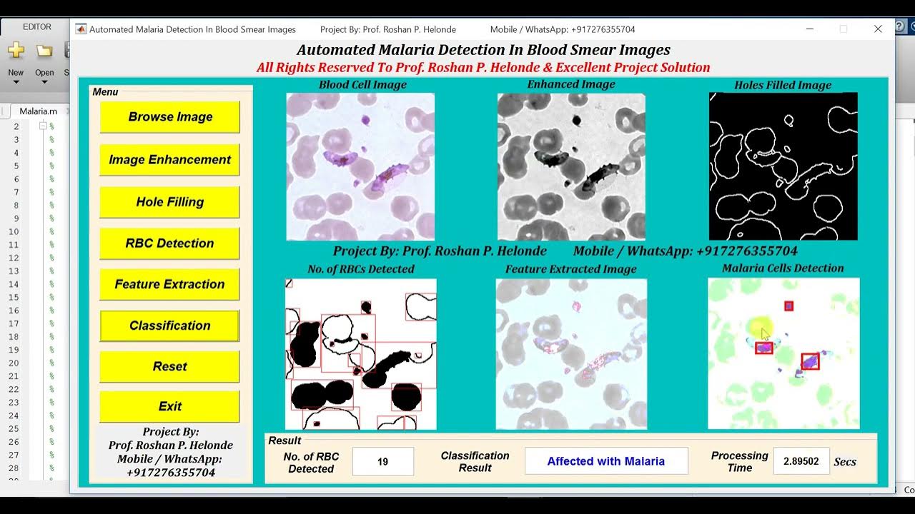 Malaria Detection Using Image Processing | IEEE Based Projects | With Source Code - YouTube