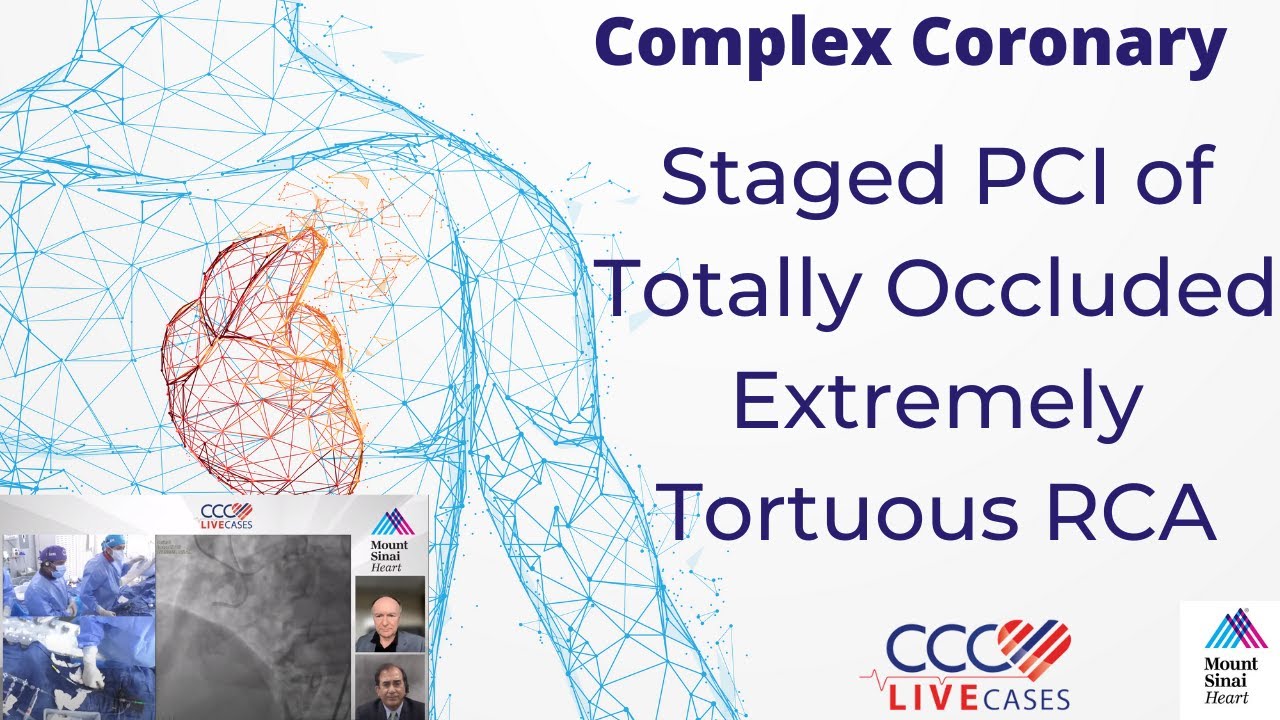Staged PCI of Totally Occluded Extremely Tortuous RCA - YouTube