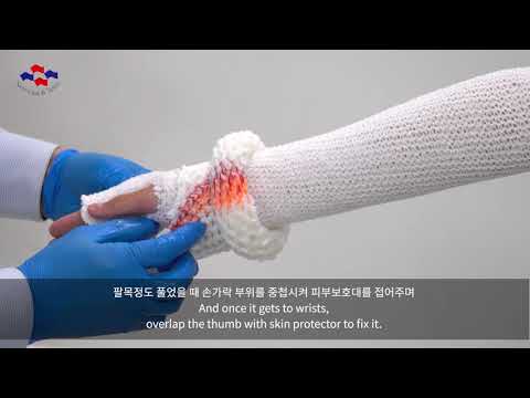 HM Cast procedure (Long arm) - YouTube