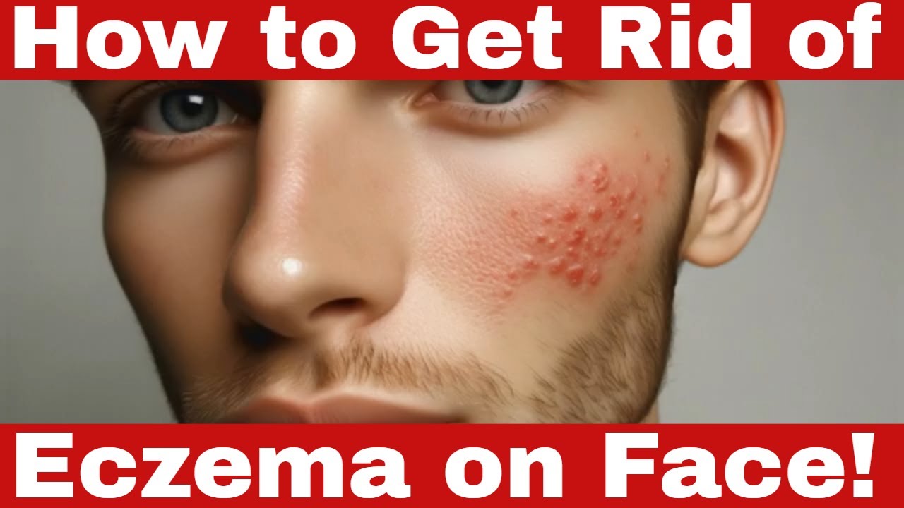 Reclaim Your Skin! How to Get Rid of Eczema on Face in Easy Steps ...