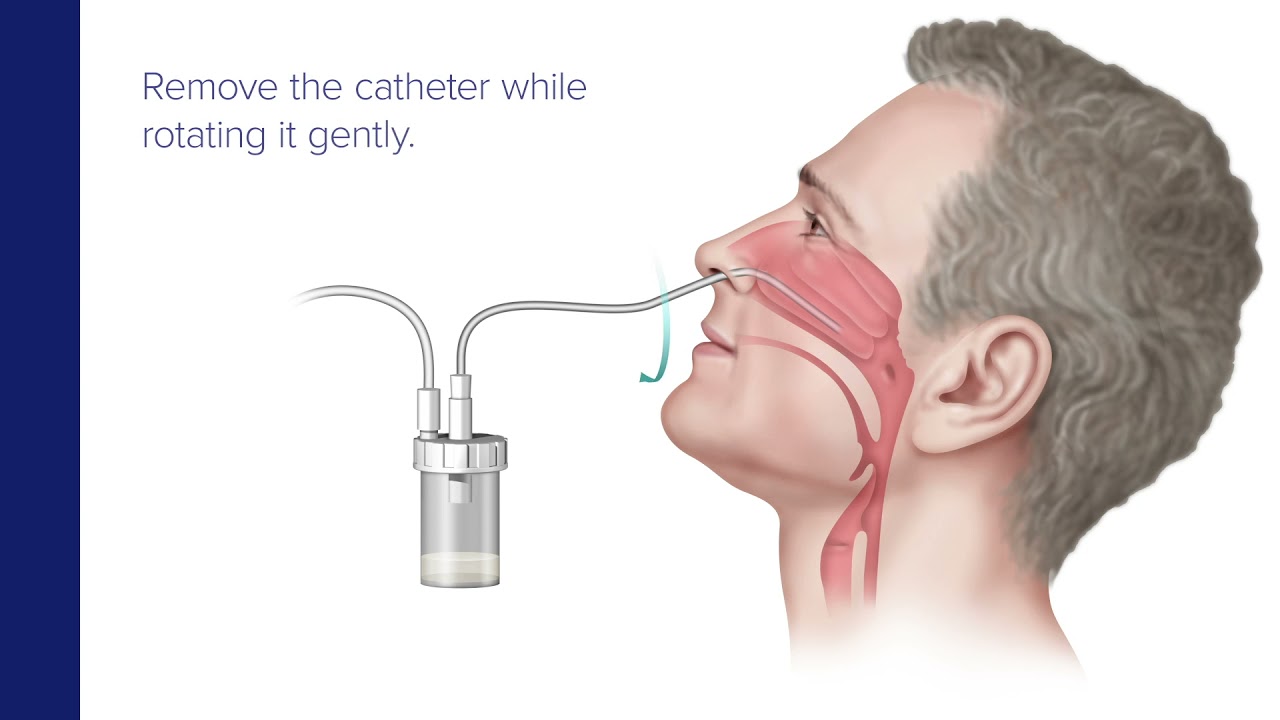 SARS-CoV-2 Clinician Collected Nasal Wash and Lower Respiratory Tract Specimen Collection Guide ...