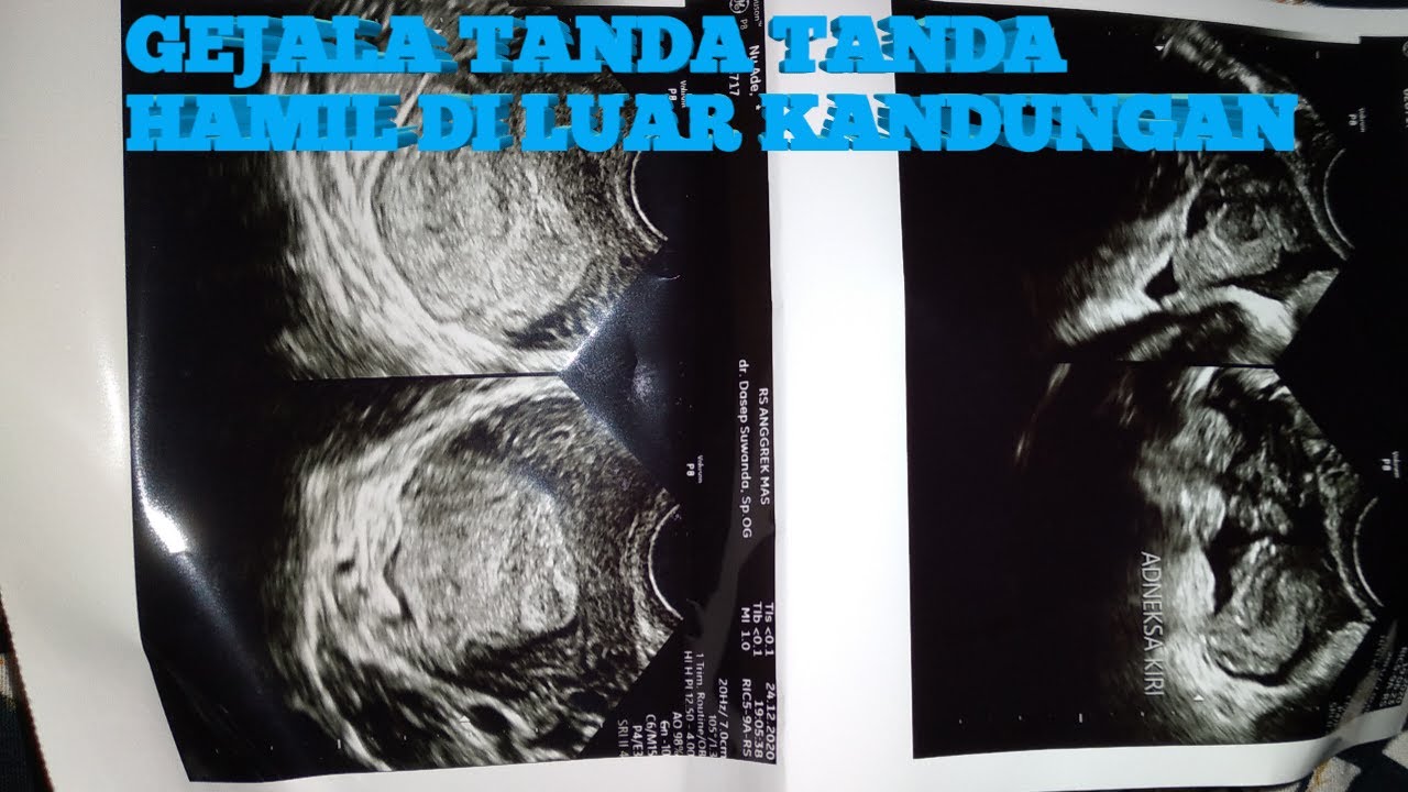 ciri ciri hamil di luar kandungan||kehamilan ektopik by ade ...