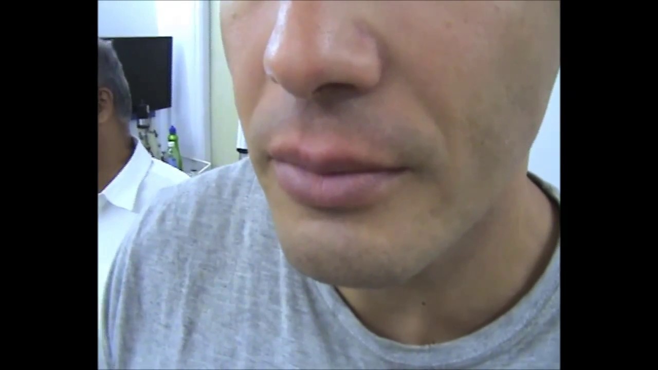 Acupuncture For Lip Augmentation - YouTube