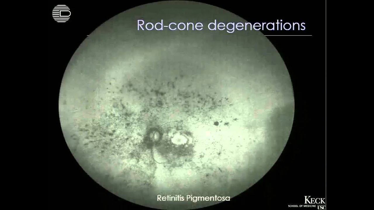 Peripheral Autofluorescence And Clinical Findings In Retinal ...