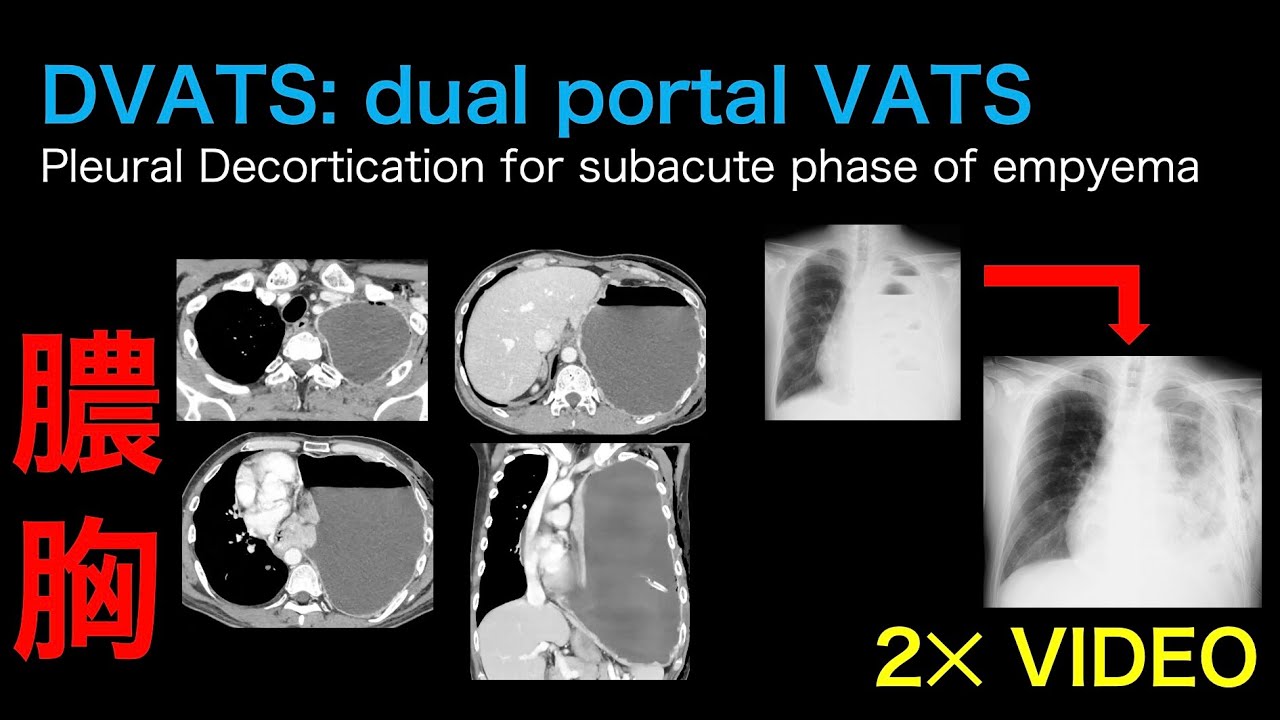 116】DVATS Pleural Decortication for a subacute phase of empyema - YouTube