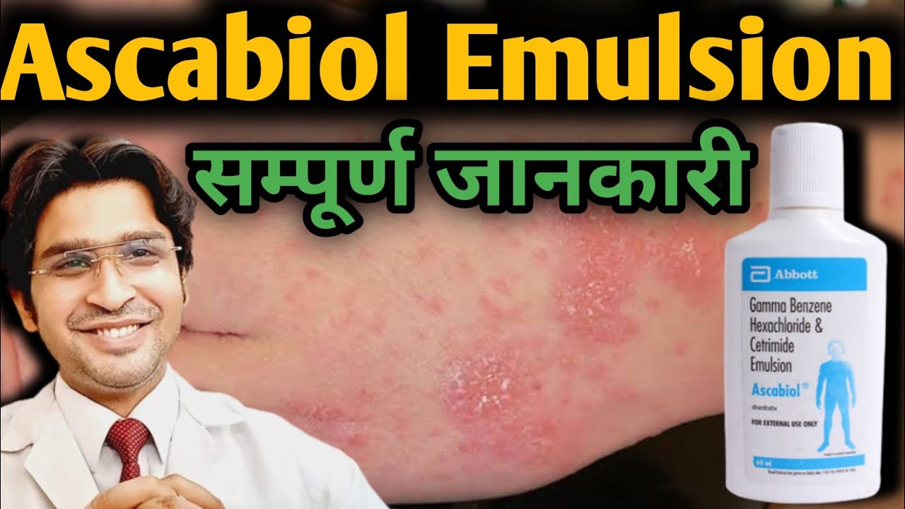 Ascabiol emulsion review.... - YouTube