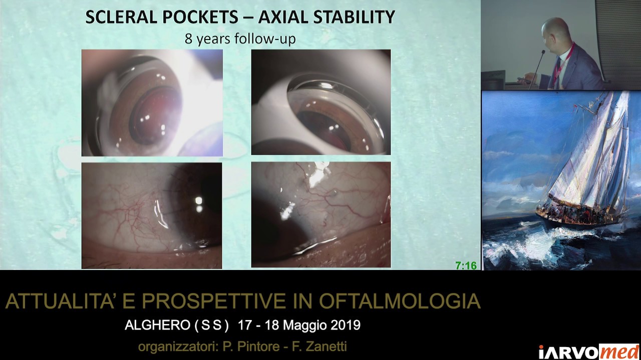 Fissazione sclerale di IOL 3 pezzi vs. Carlevale Lens - Carlo Carlevale ...