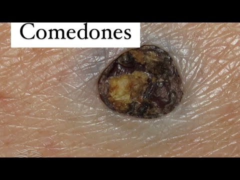 Solar & Senile Comedones! What are they? - YouTube