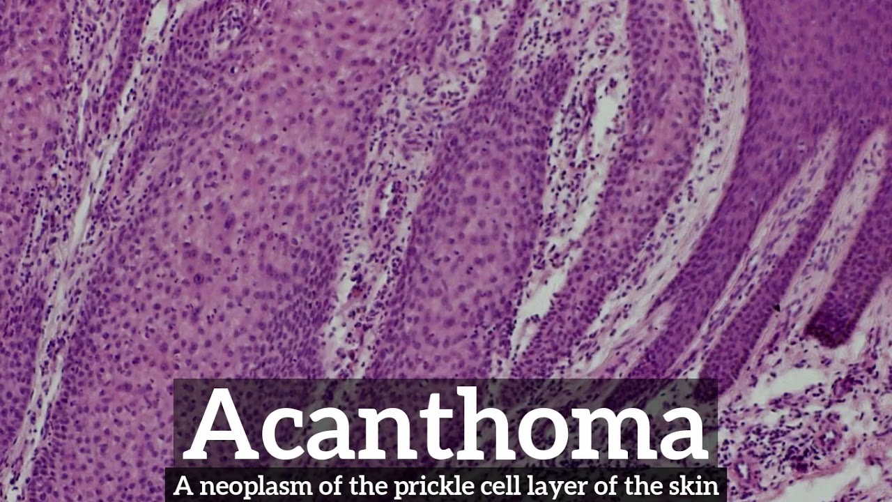What is Acanthoma? | How to Say Acanthoma in English? | How Does ...