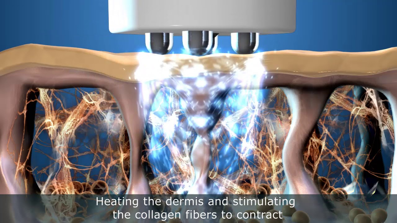 Pollogen Tripollar Technology - YouTube