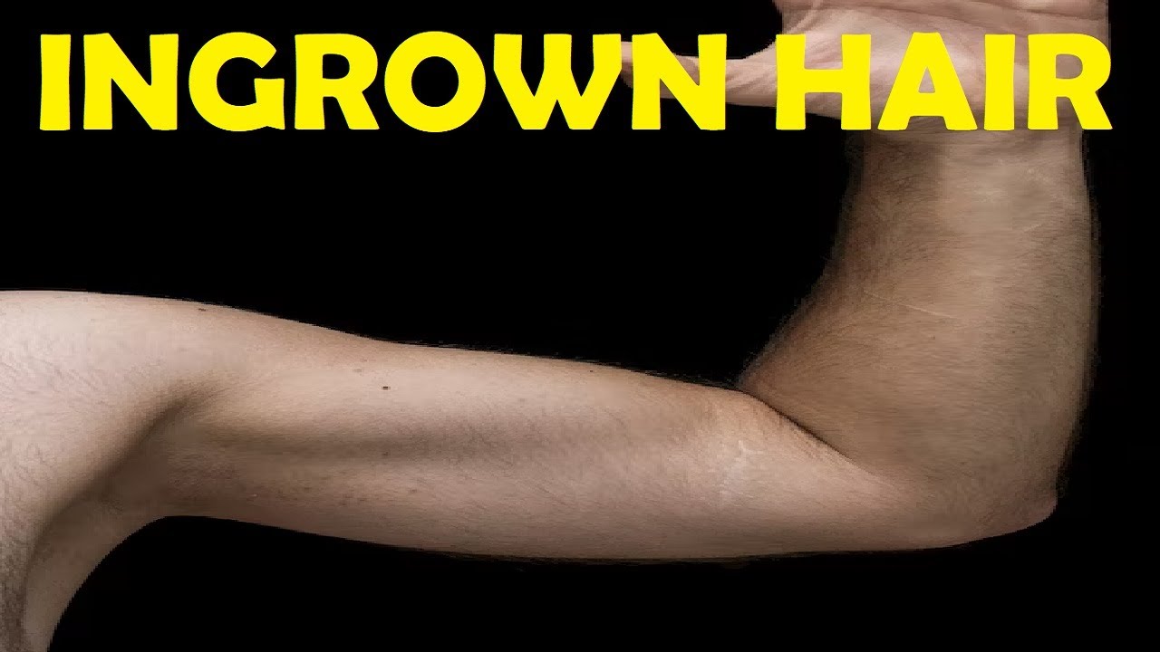 how to get rid of ingrown armpit hairs quickly - YouTube