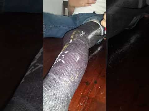 How to cut ur cast off - YouTube