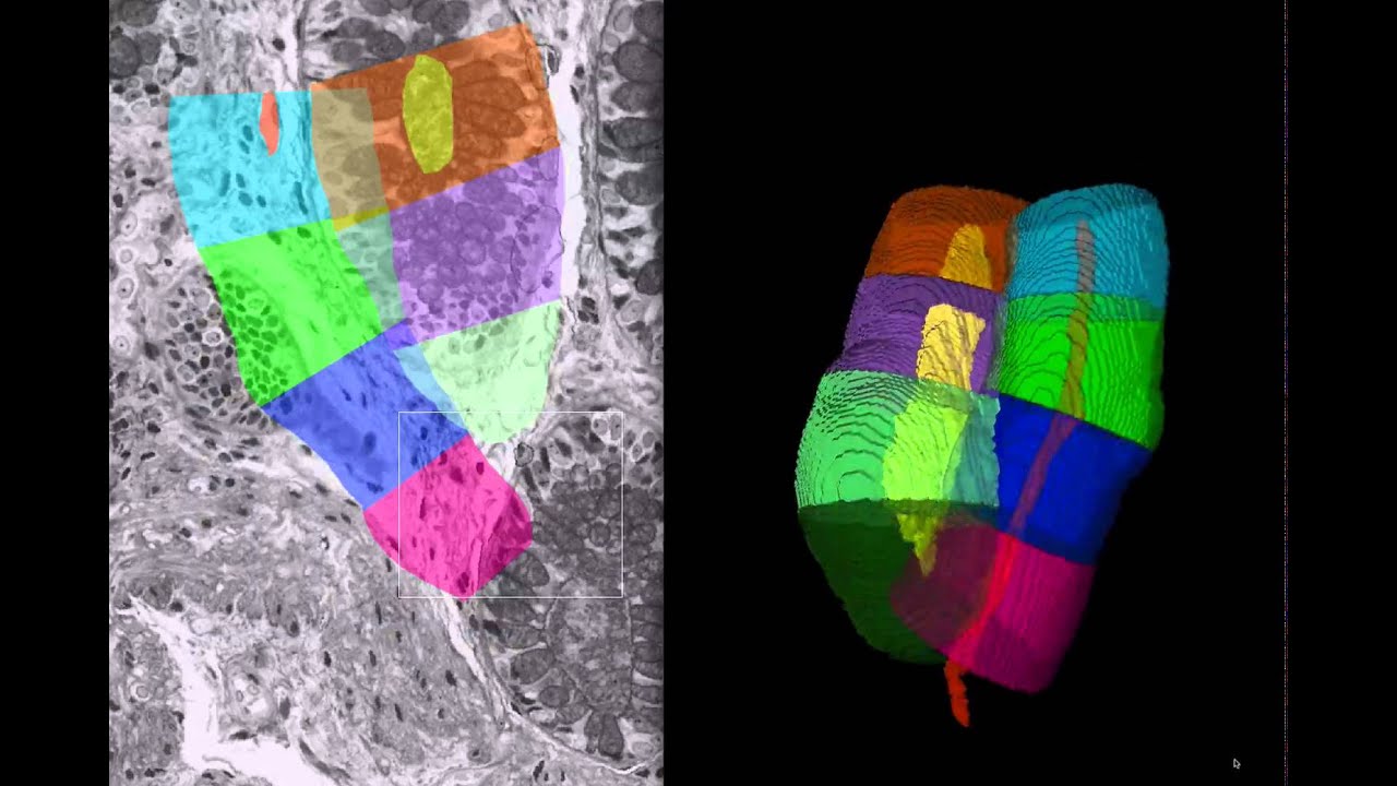 FTUs in colon - YouTube