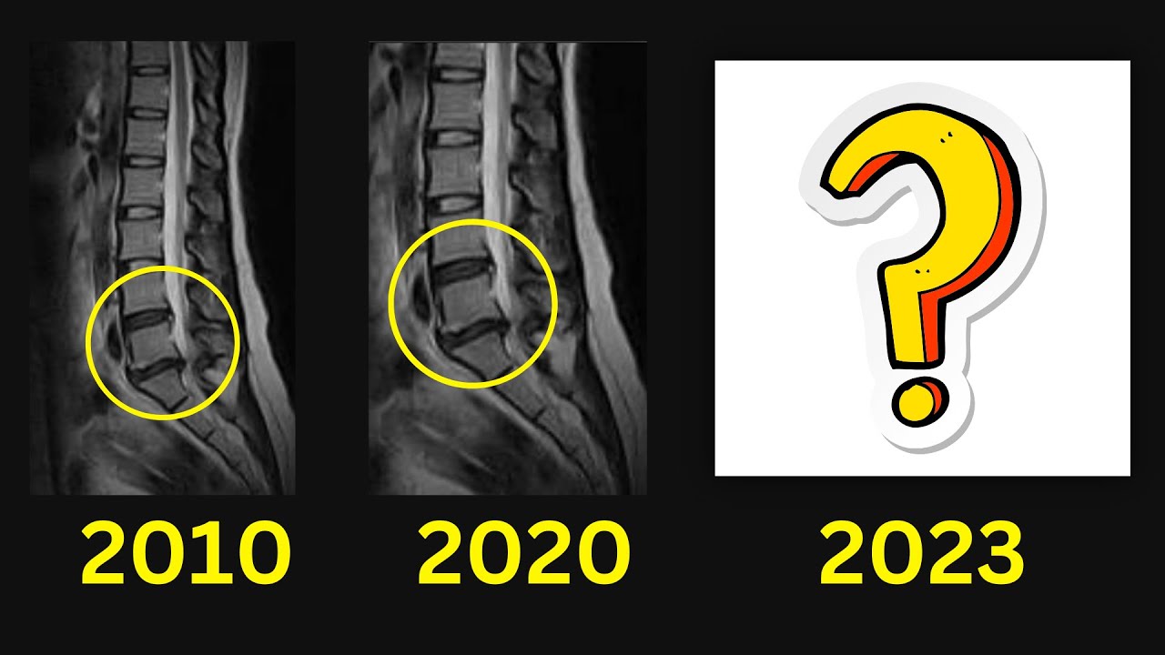 Lumbar Spinal Stenosis Recovery Without Surgery After 14 Years YouTube
